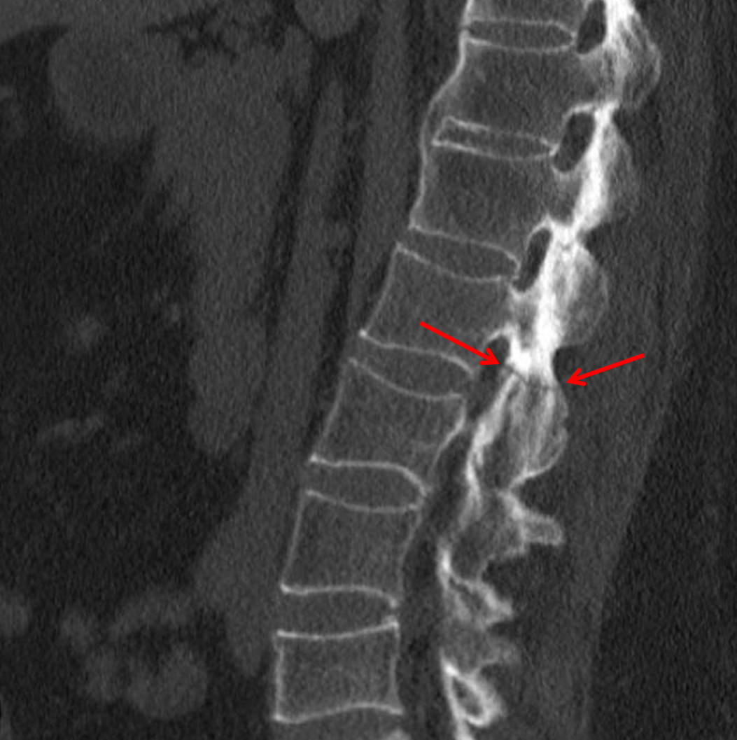 CaseStacks.com - Neuroradiology CT Case #33