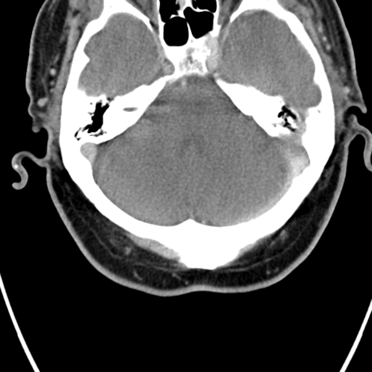 CaseStacks.com - Neuroradiology CT Case #14