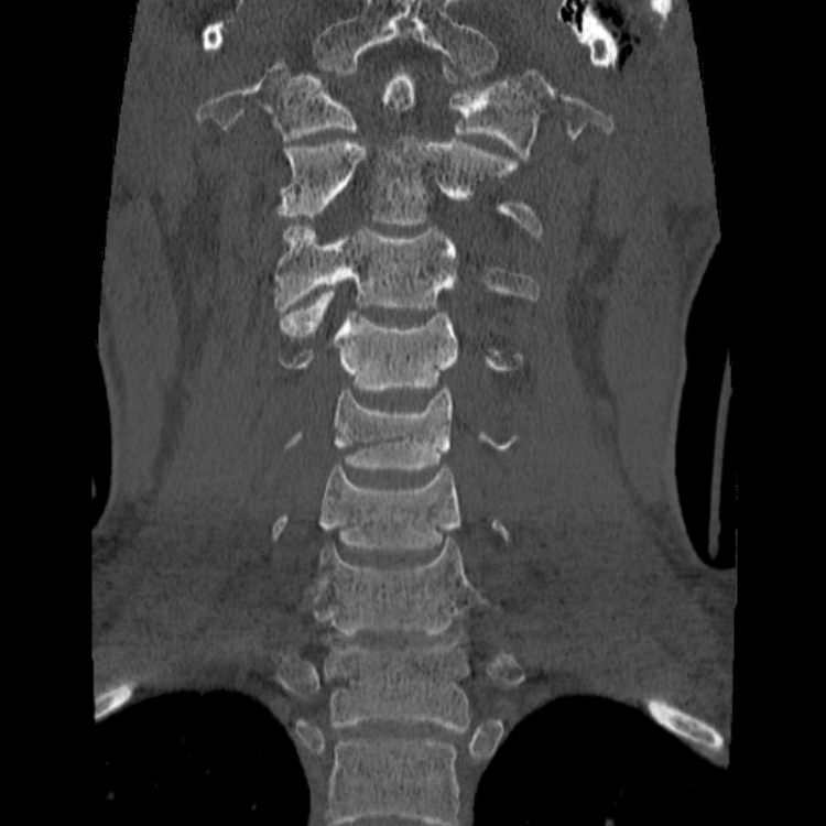 CaseStacks.com - Occipital condyle fracture on Spine CT