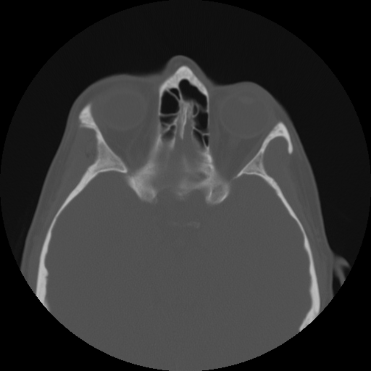 CaseStacks.com - Neuroradiology CT Case #23