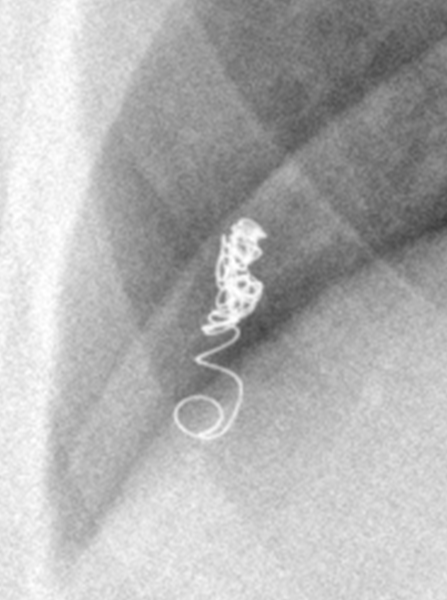 embolization coil | CaseStacks.com