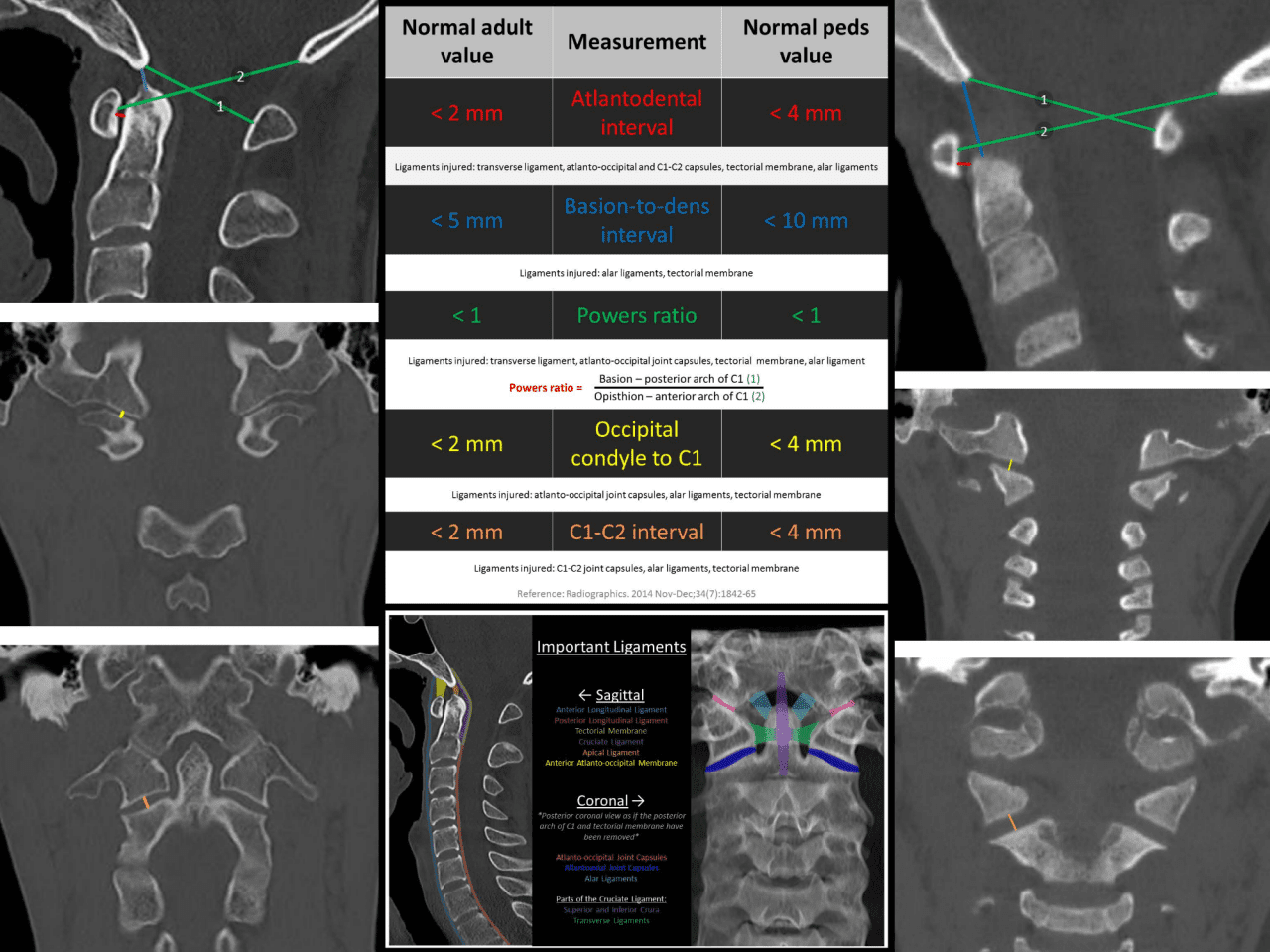 CaseStacks.com - Neuroradiology CT Illustrations, Diagrams, and Videos