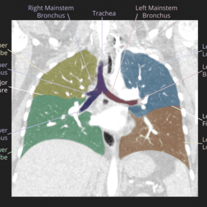 Chest Anatomy on CT & Radiograph | CaseStacks.com