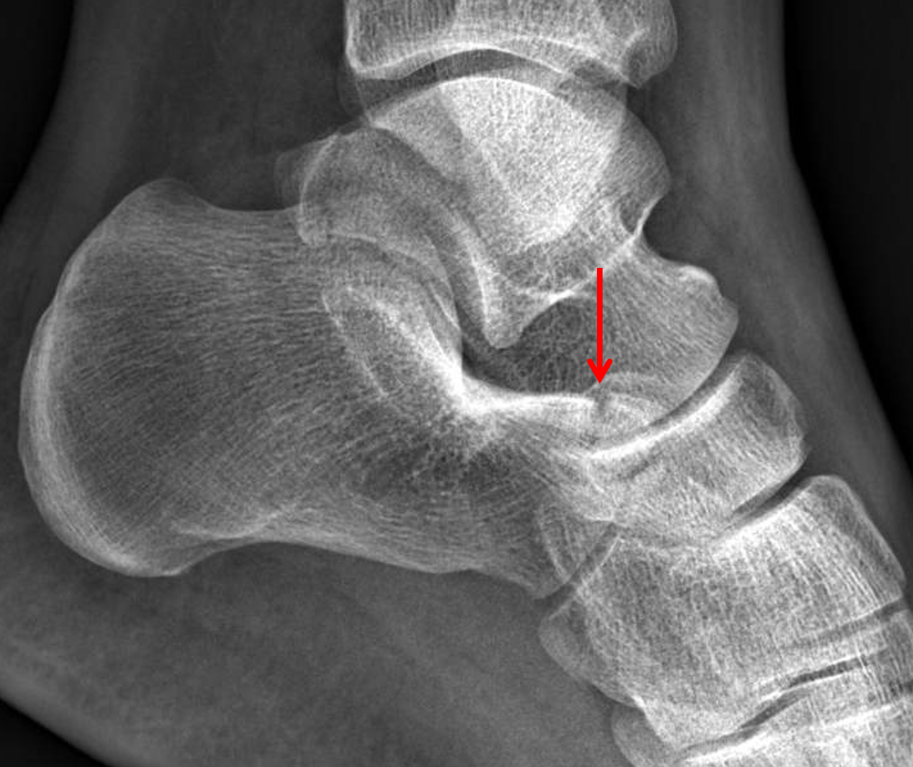 Calcaneal