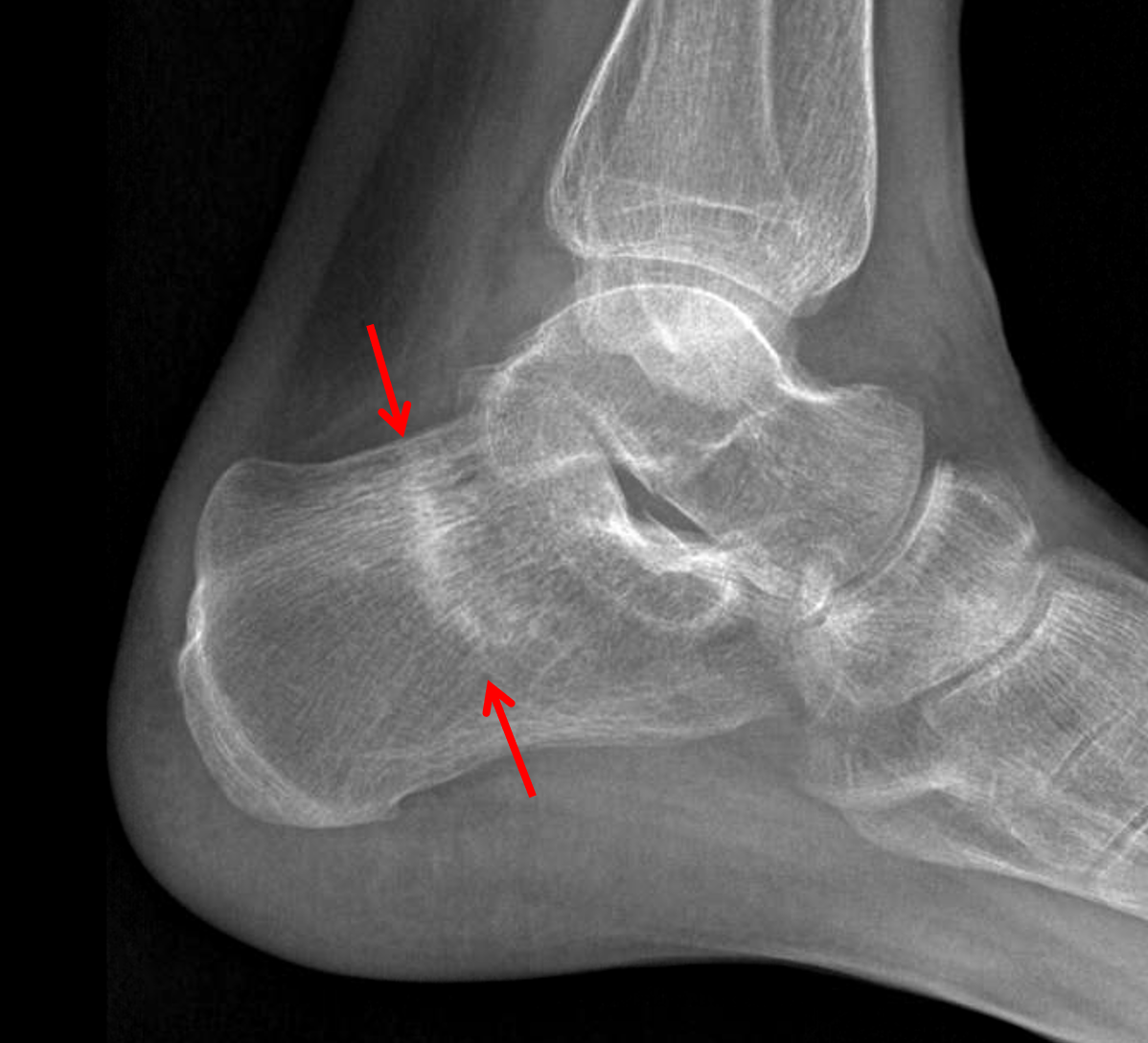 Calcaneus Stress Fracture