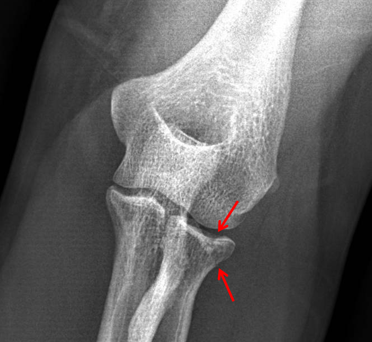 Intra Articular Radius Fracture