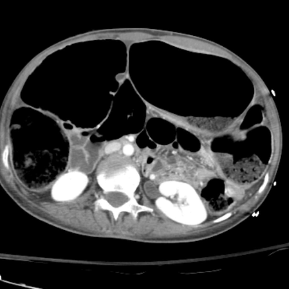 Case #11 - CaseStacks.com