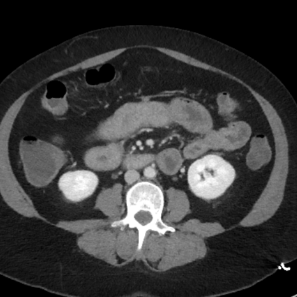 Case #11 - CaseStacks.com