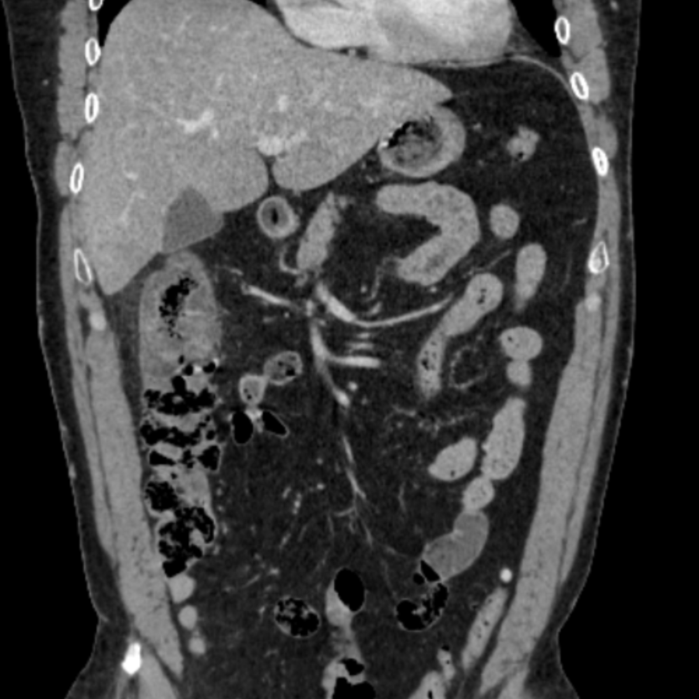 Case #14 - CaseStacks.com