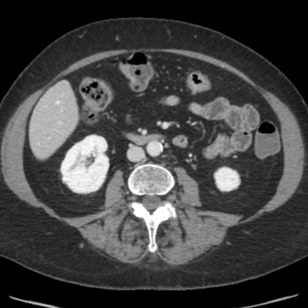 Case #20 - CaseStacks.com