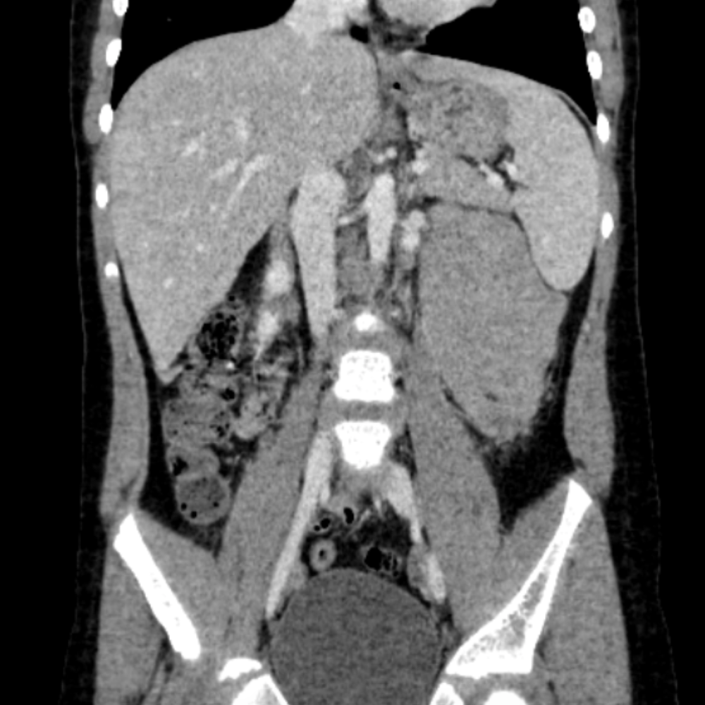 Case #13 - CaseStacks.com
