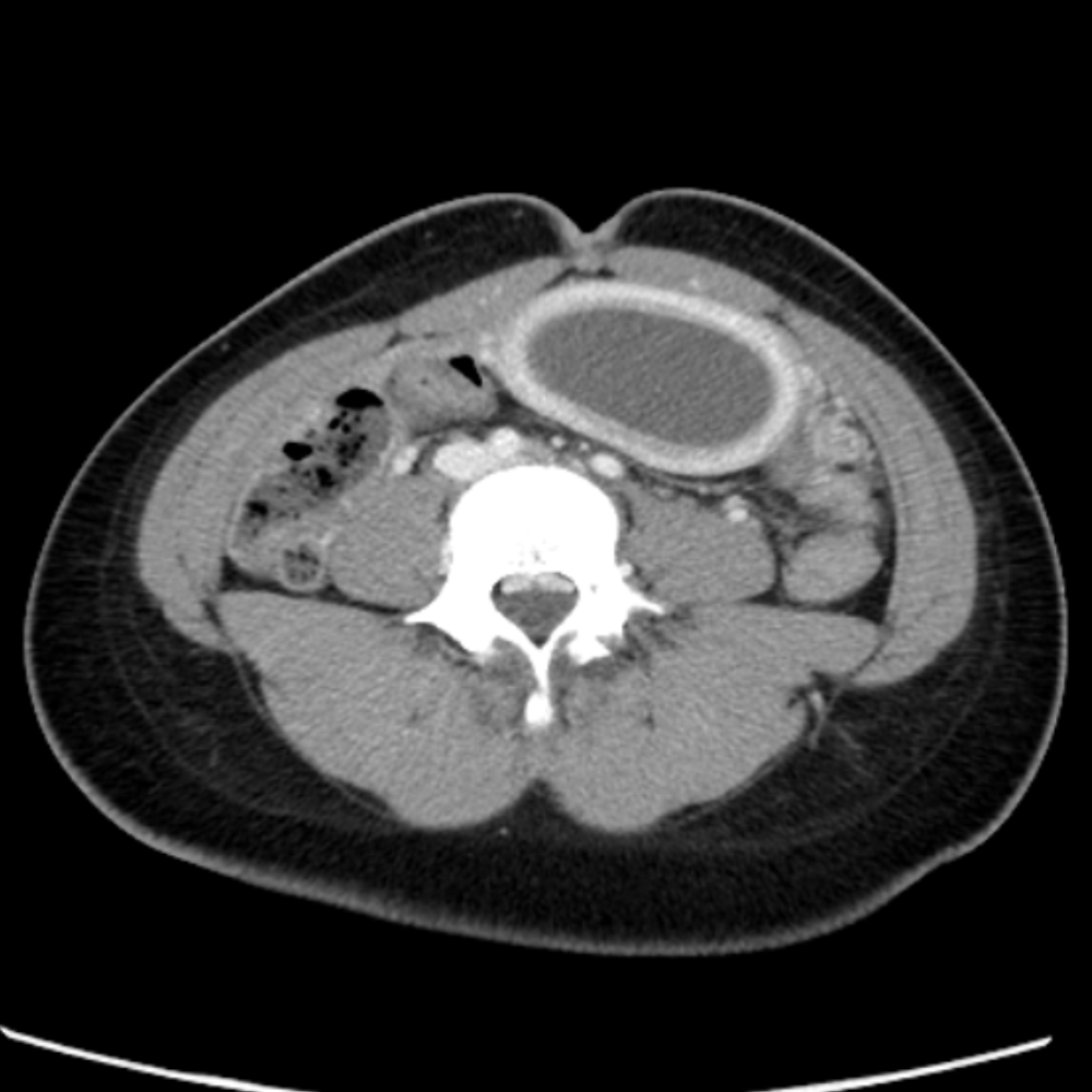 CaseStacks.com - Body-CT Case #46