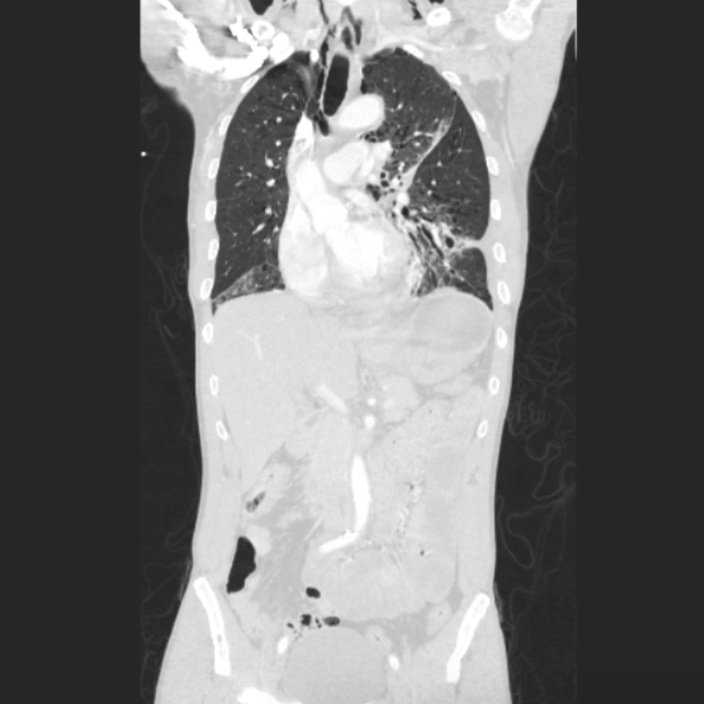 CaseStacks.com - Chest CT Case #30