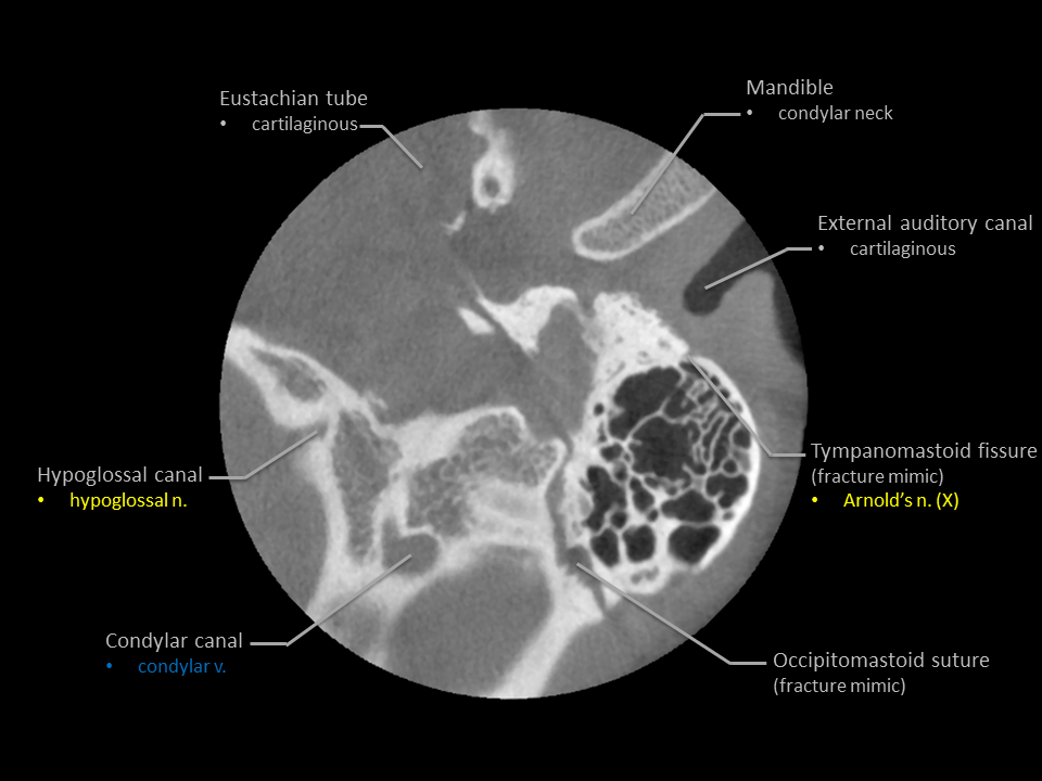 Ct Anatomy Of Temporal Bone Temporal Bone Radiology | SpringerLink