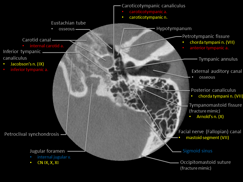 Temporal Bone Ct Anatomy Interactive Web Based Learning Module On CT