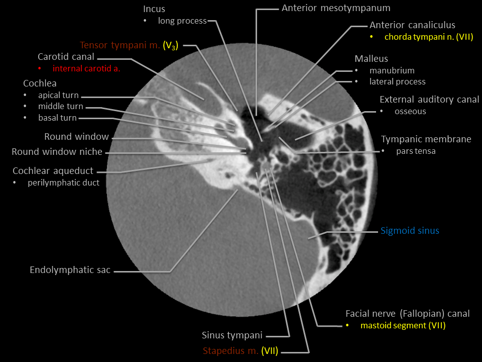 Temporal Bone Labeled