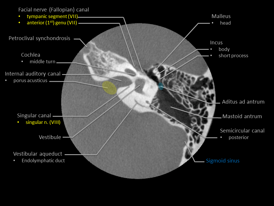 Temporal Bone Anatomy