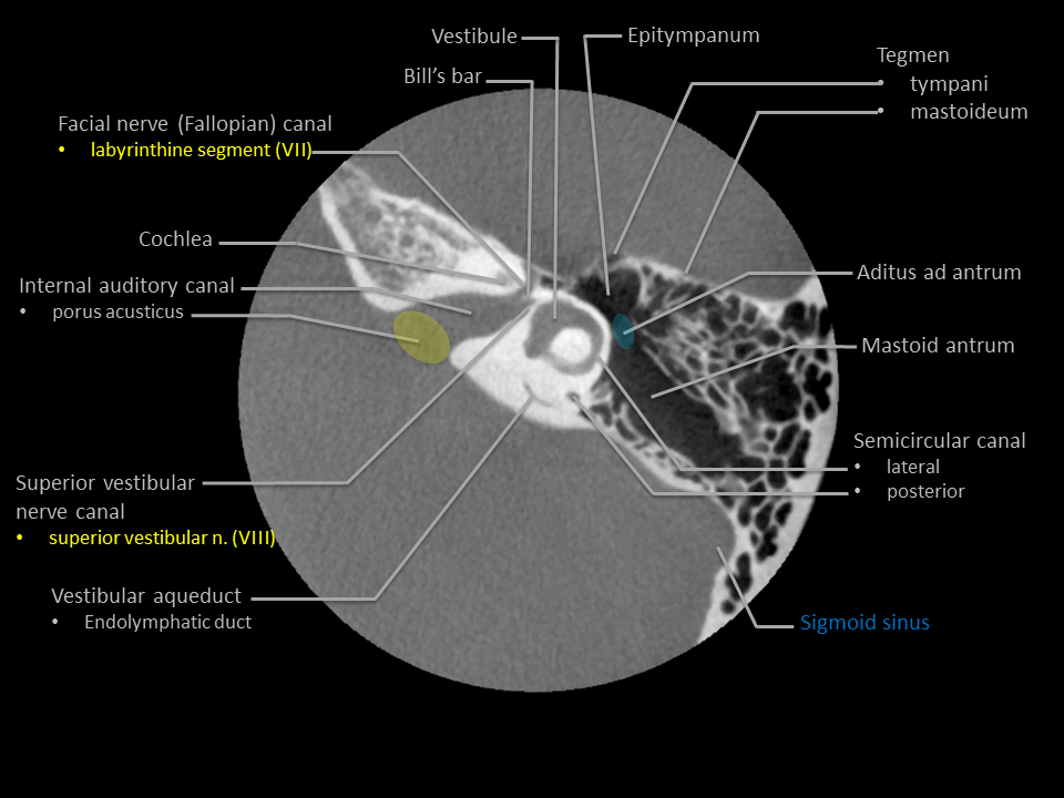 Temporal Bone Anatomy Ct