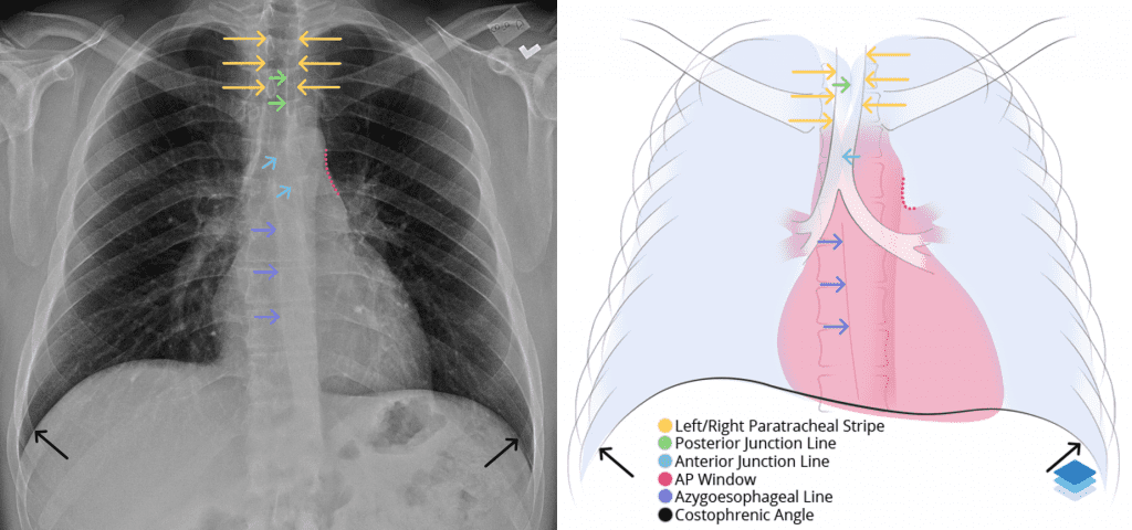 PA Lines and Interfaces | CaseStacks.com