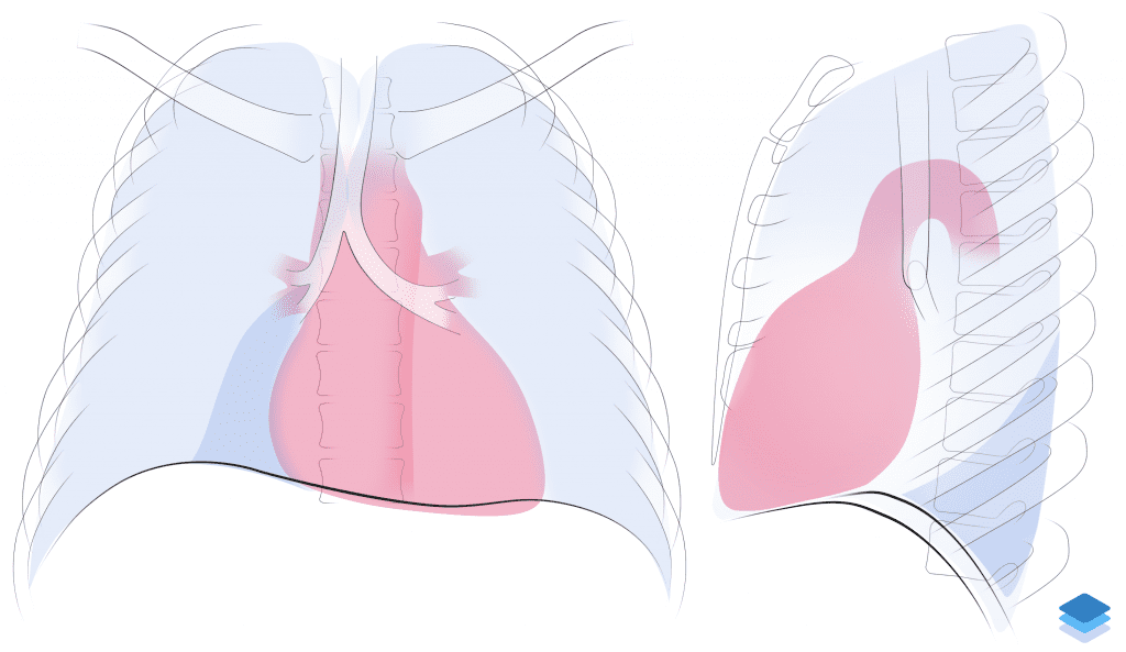 Right Lower Lobe Collapse | CaseStacks.com