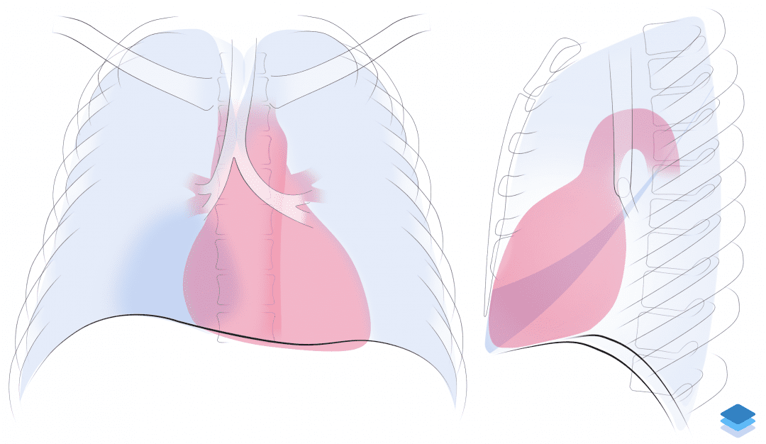 Right Middle Lobe Collapse | CaseStacks.com