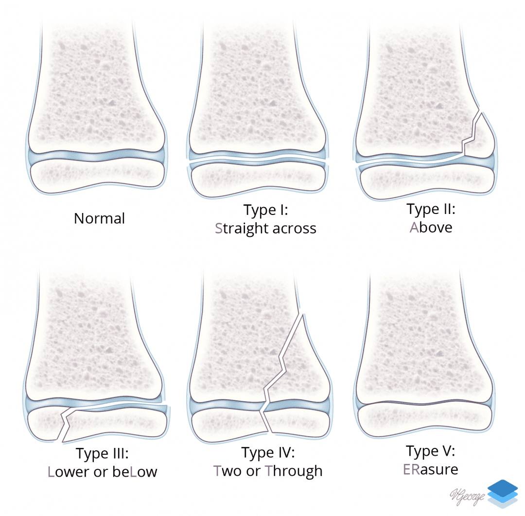 Salter Harris Fractures | CaseStacks.com