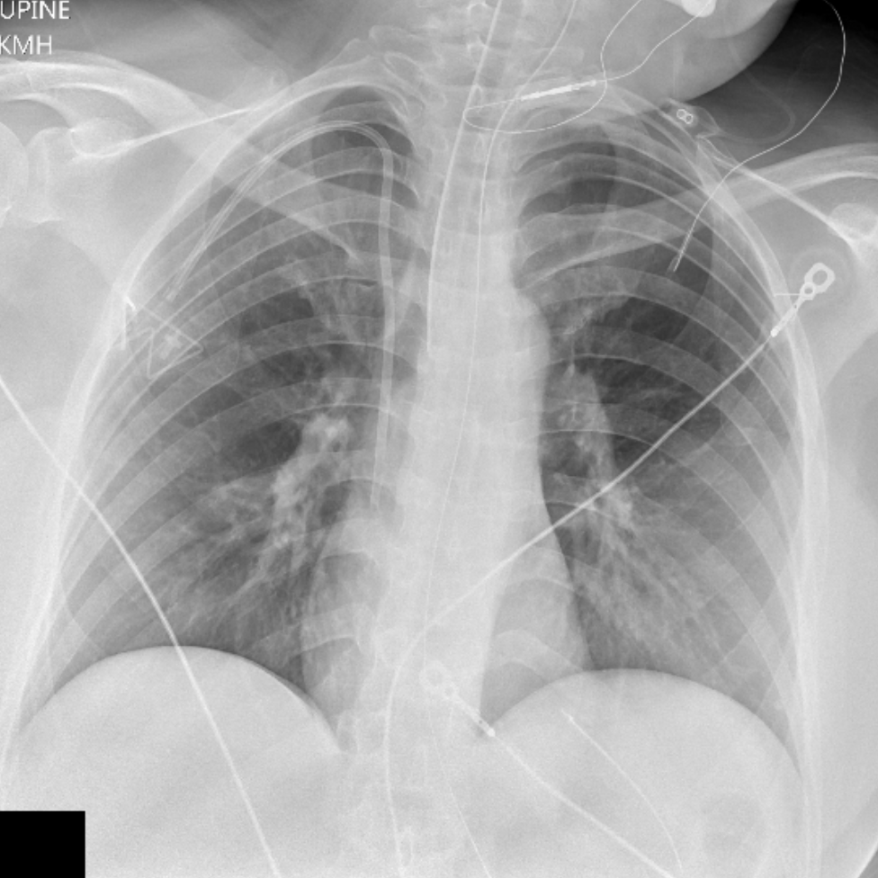 CaseStacks.com - Chest CT Case #22