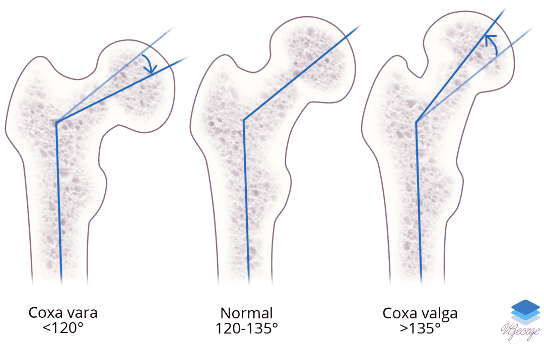 Varus and Valgus Alignment of the Proximal Femur | CaseStacks.com