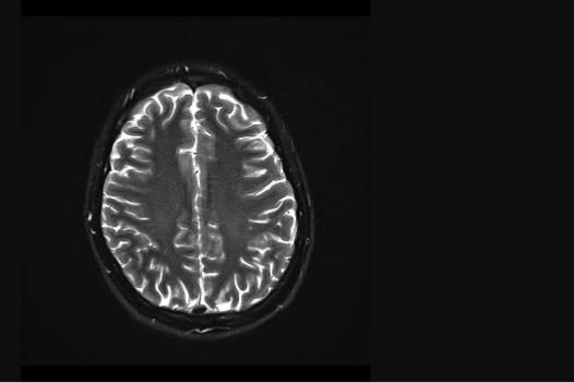 Axial Brain Mri