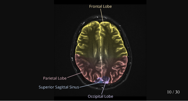 Normal Brain Mri Labeled