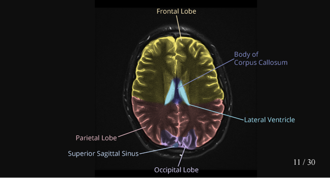 Axial Head Mri Scan