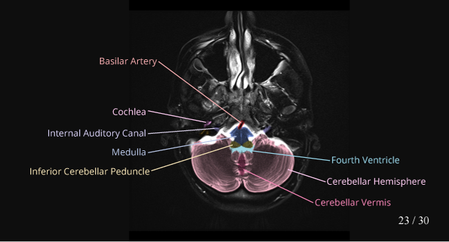 Brain Mri Labeled Brain Scanning | MRI, CT & PET Imaging | Britannica
