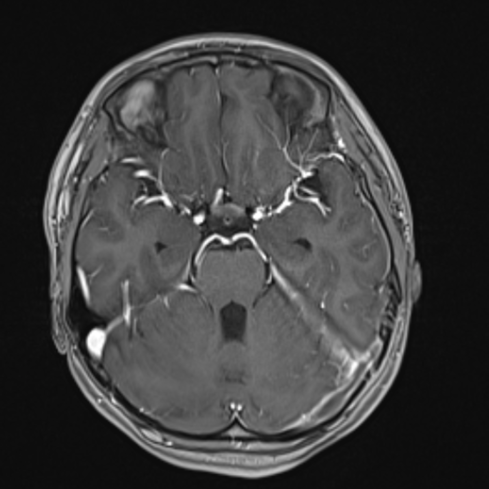 CaseStacks.com - Neuroradiology MRI Case #3
