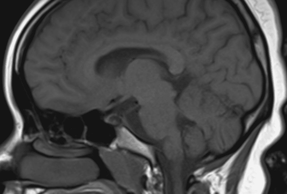 Neuroradiology MRI | CaseStacks.com