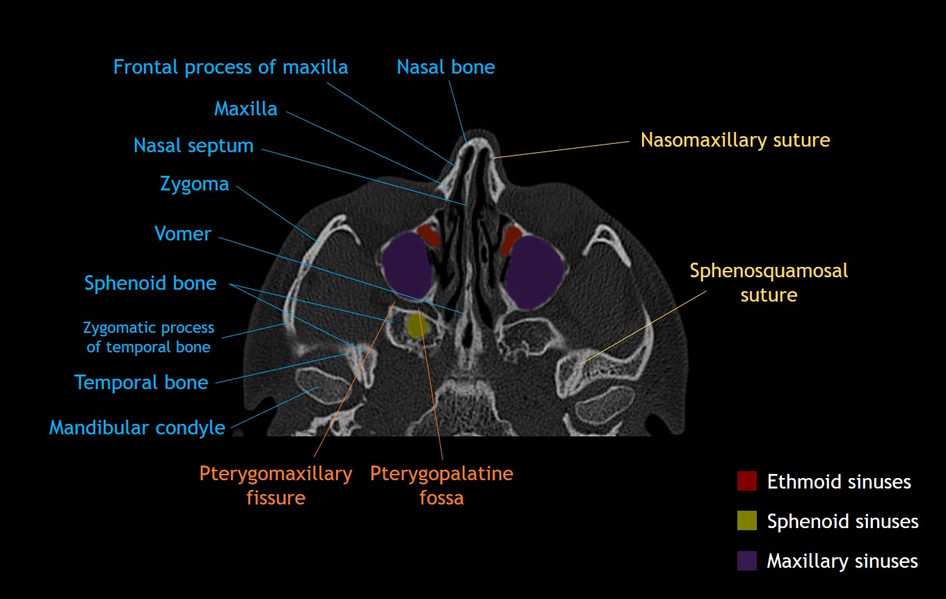 CT Axial Face Anatomy | CaseStacks.com