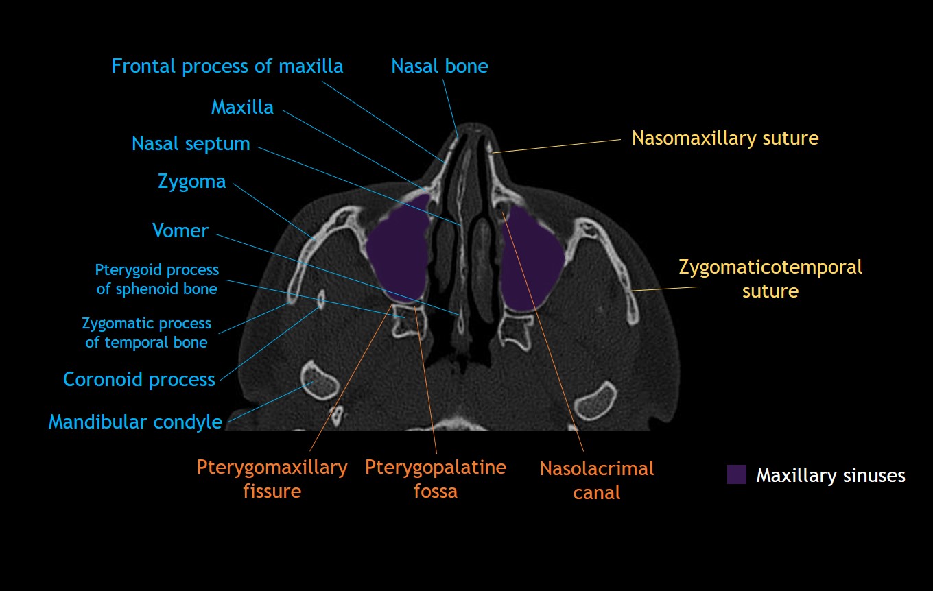 Nasal Bone Anatomy Ct