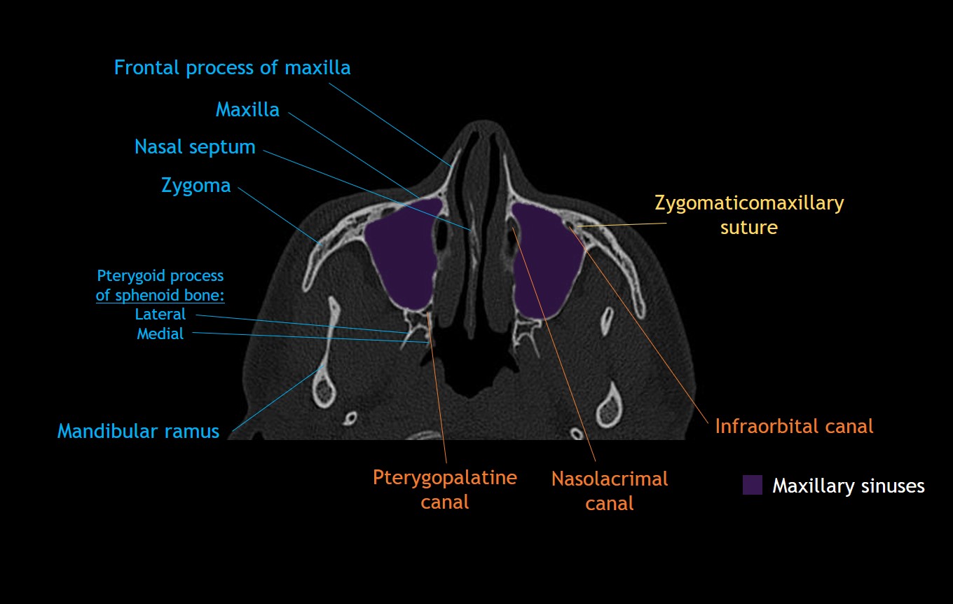 CT Axial Face Anatomy | CaseStacks.com