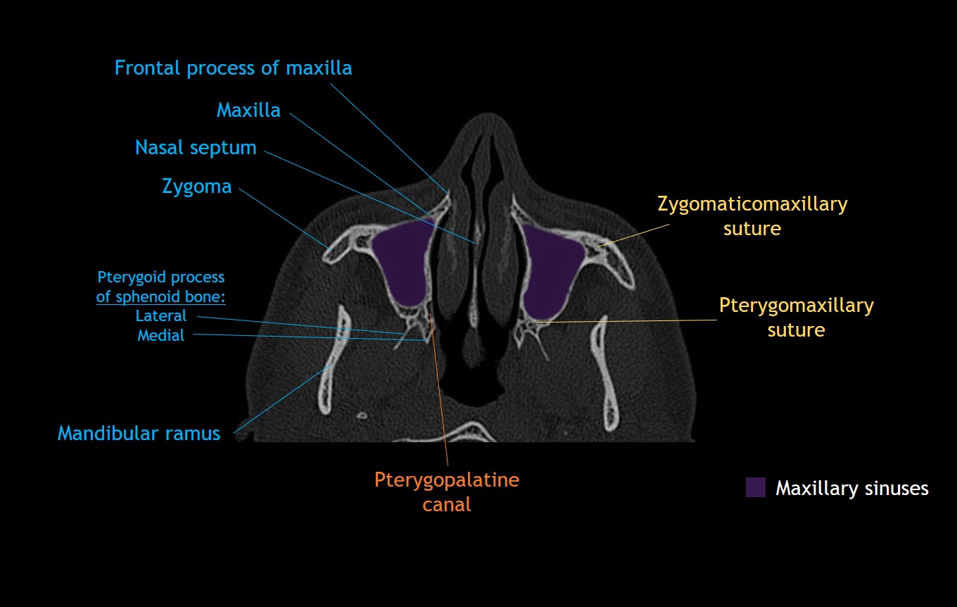 CT Axial Face Anatomy | CaseStacks.com
