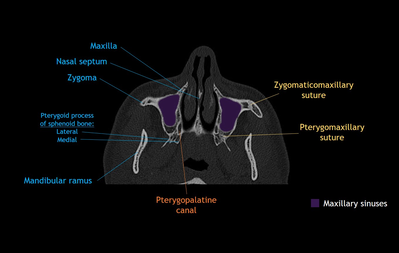 CT Axial Face Anatomy | CaseStacks.com