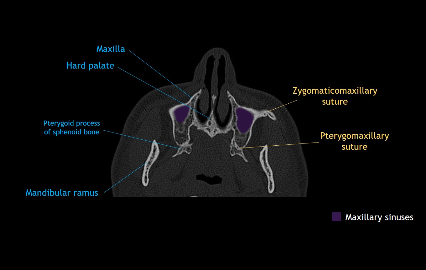 CT Axial Face Anatomy | CaseStacks.com
