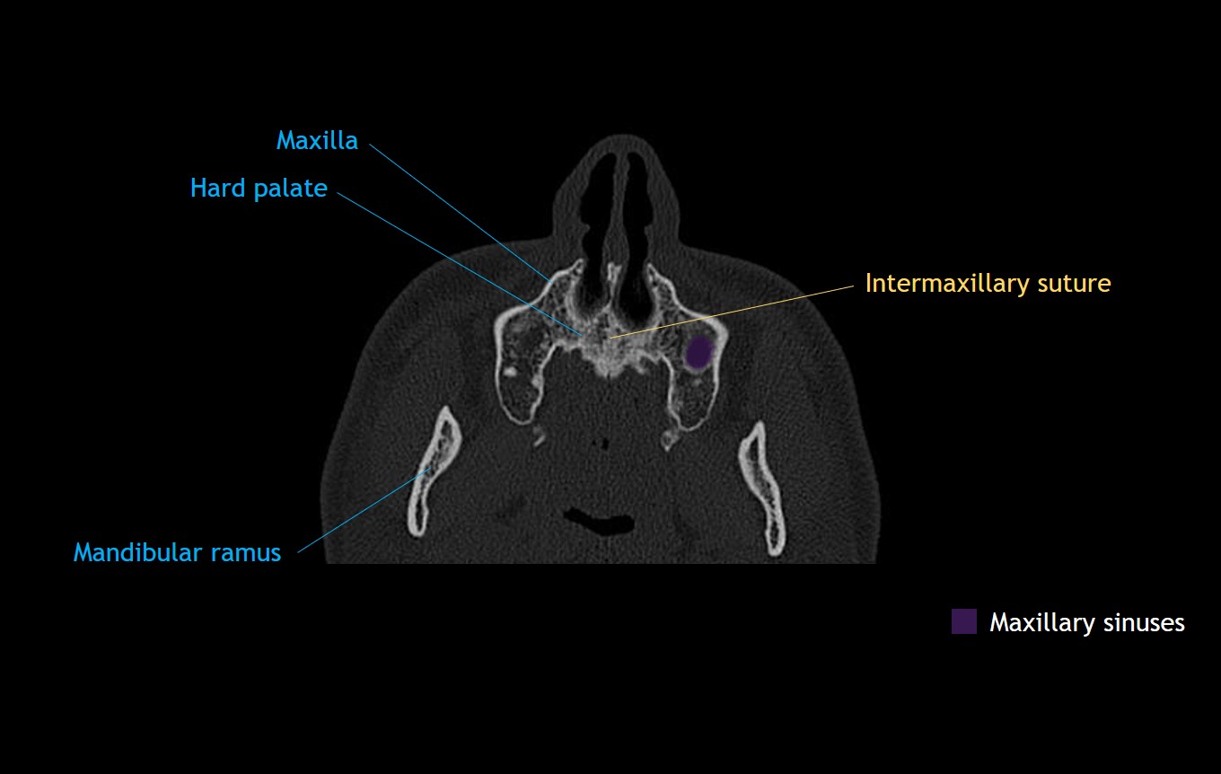 Face Bone Anatomy Ct