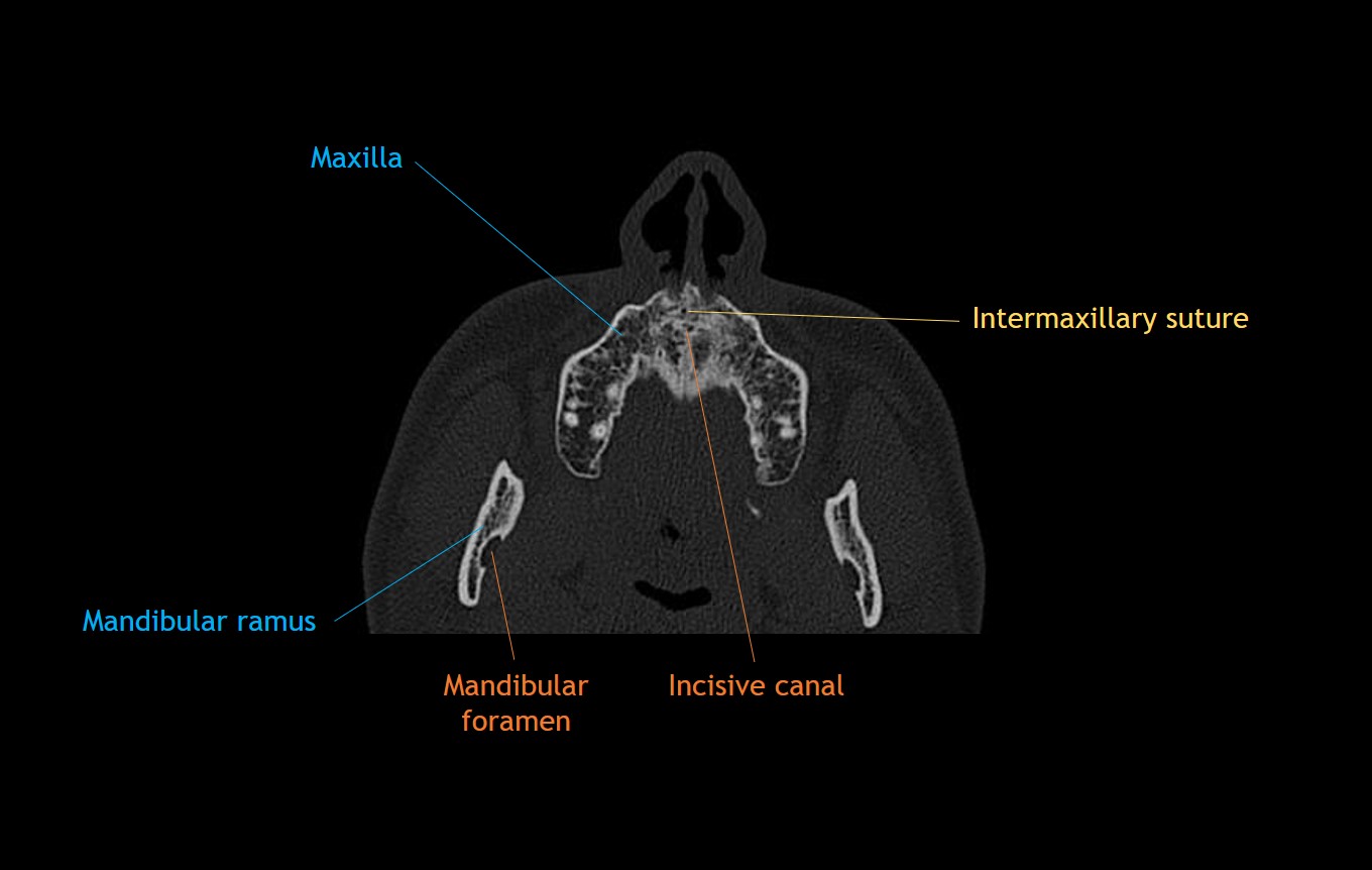 CT Axial Face Anatomy | CaseStacks.com