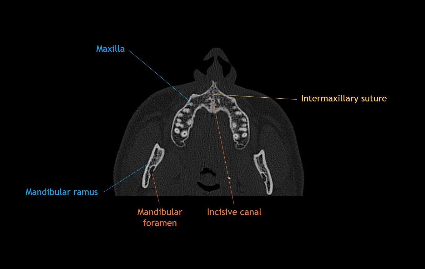 Face Bone Anatomy Ct
