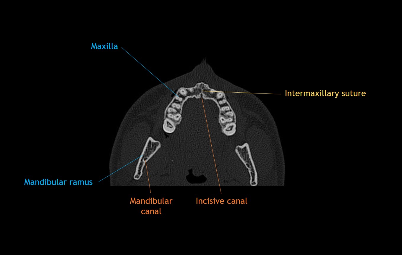 CT Axial Face Anatomy | CaseStacks.com