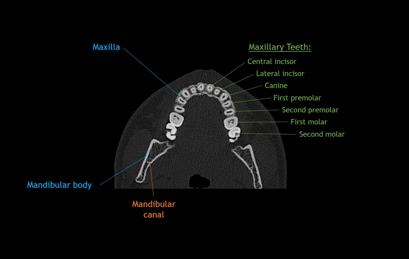CT Axial Face Anatomy | CaseStacks.com