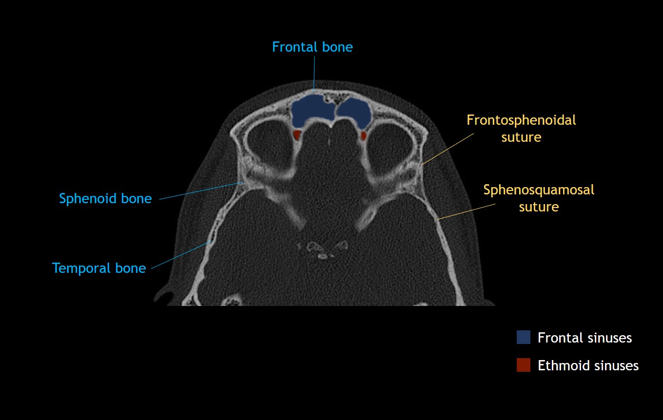 Cranial Bone Anatomy Ct Axial