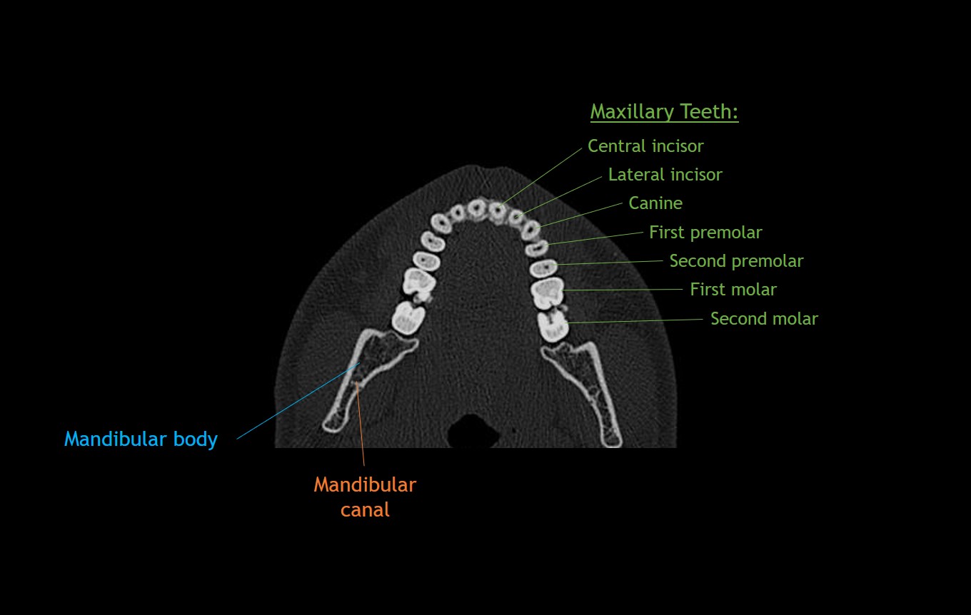 CT Axial Face Anatomy | CaseStacks.com