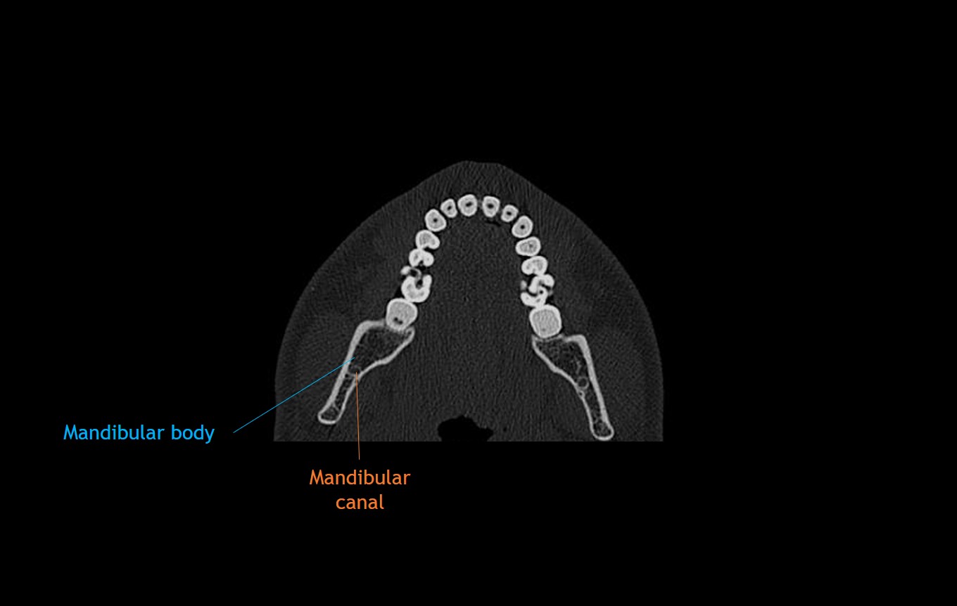 CT Axial Face Anatomy | CaseStacks.com