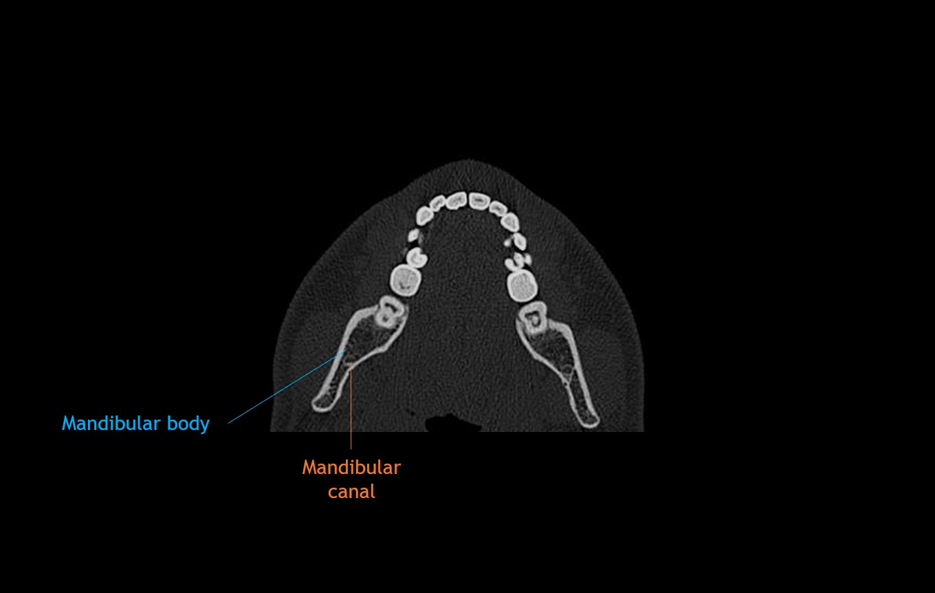 CT Axial Face Anatomy | CaseStacks.com