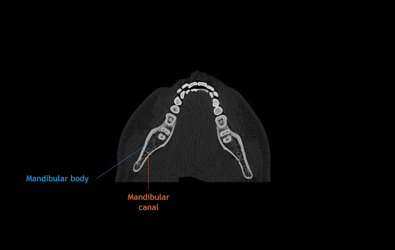 CT Axial Face Anatomy | CaseStacks.com